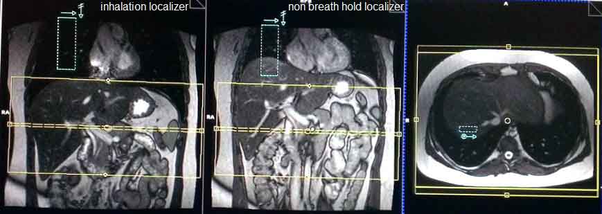 تکنیک MRI کلانژیوپانکراتوگرافی(MRCP) - MriNext
