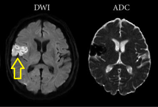 سکانس DWI - MriNext