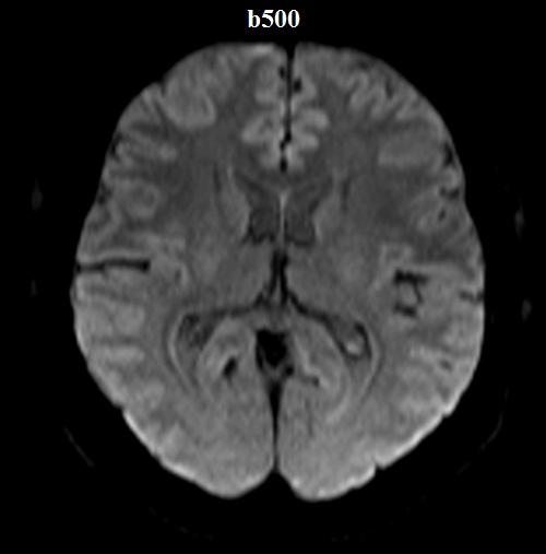 سکانس DWI - MriNext