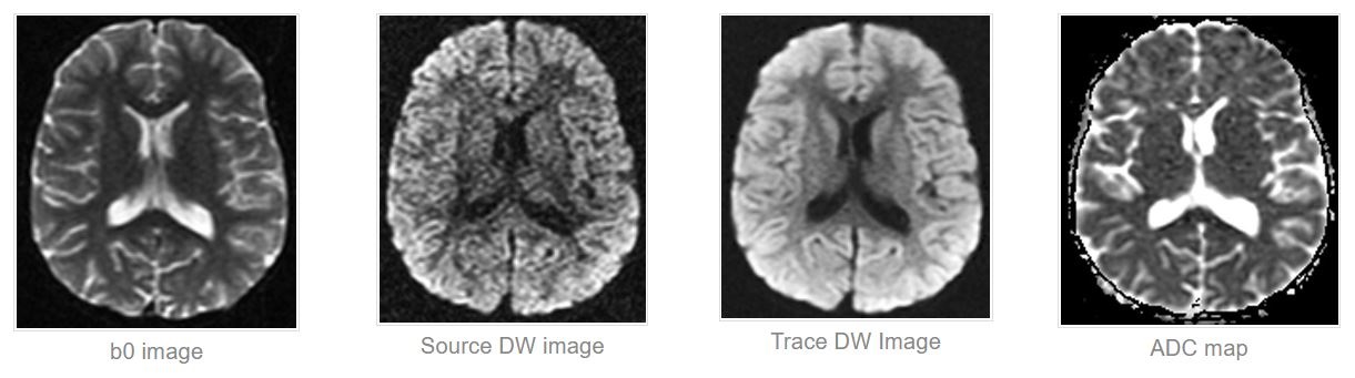 سکانس DWI - MriNext