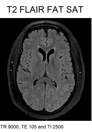سکانس FLAIR - MriNext