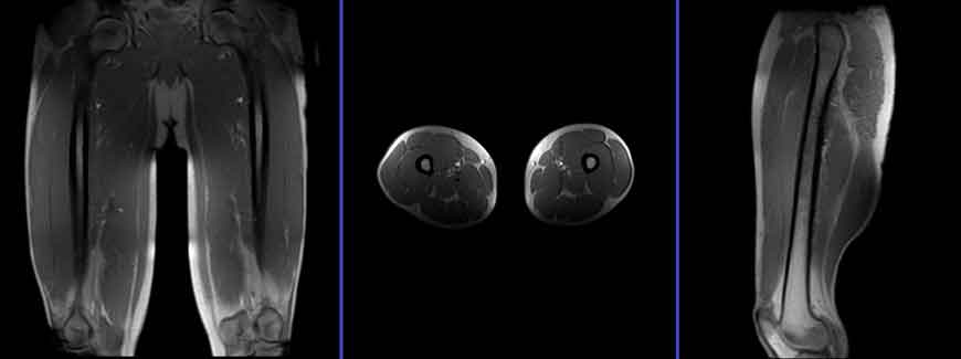 MR آنژیوگرافی عروق پریفرال - MriNext