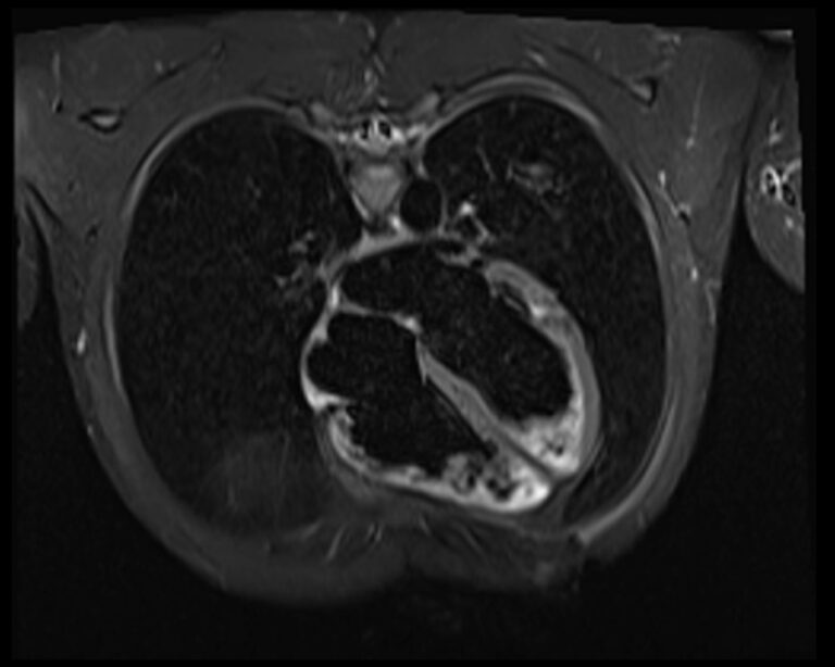 سکانس STIR - MriNext
