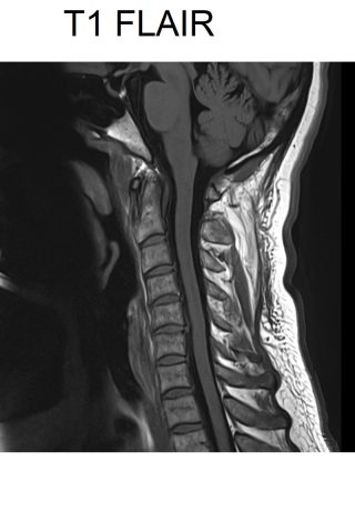 سکانس FLAIR - MriNext