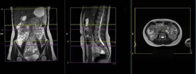 تکنیک MRI روده کوچک(اینتروگرافی) - MriNext
