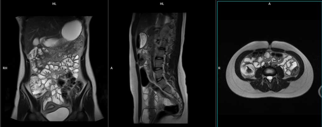 تکنیک MRI روده کوچک(اینتروگرافی) - MriNext